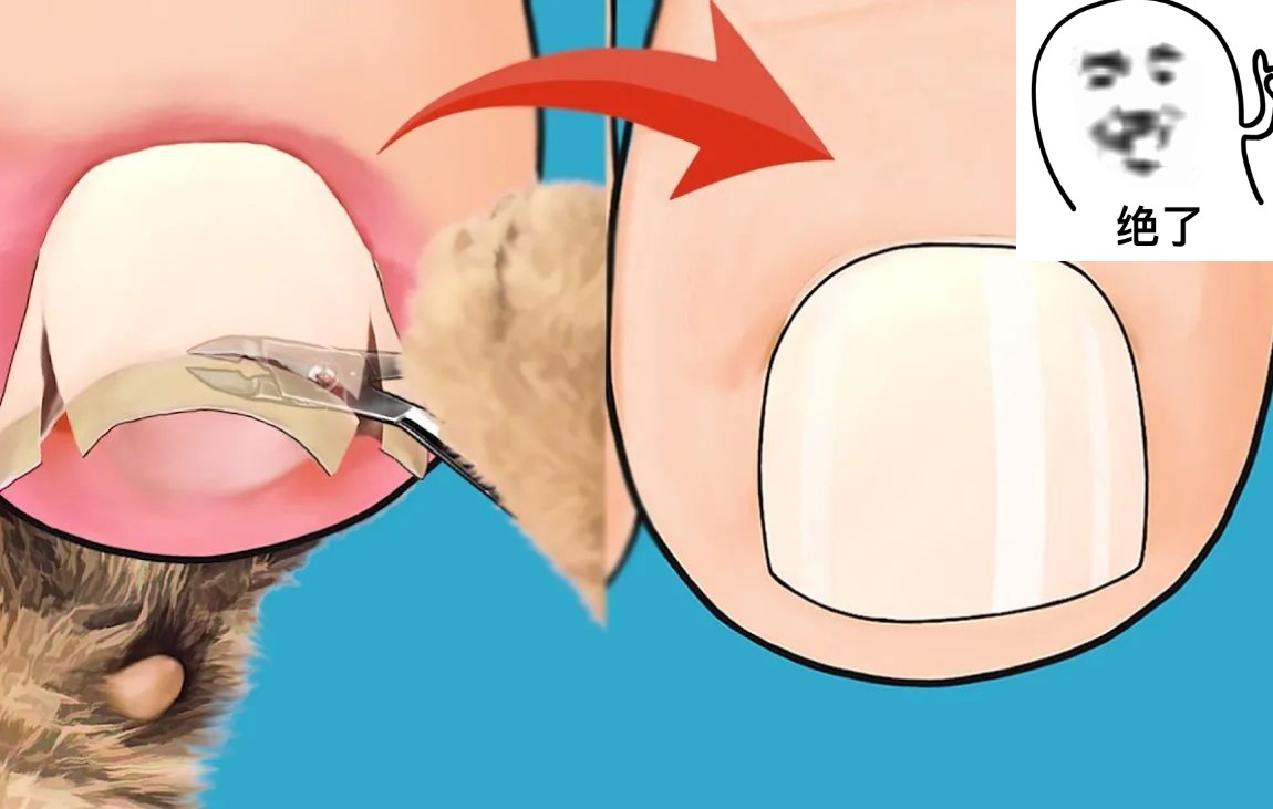 【沉浸式修脚】 吃饭别看 内生脚趾甲治疗动画