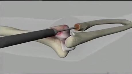 桡骨头置换术3D动画版,这画面看得确实清晰,结构流程简单明了!