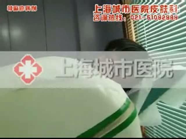 荨麻疹在线咨询-上海城市医院皮肤科