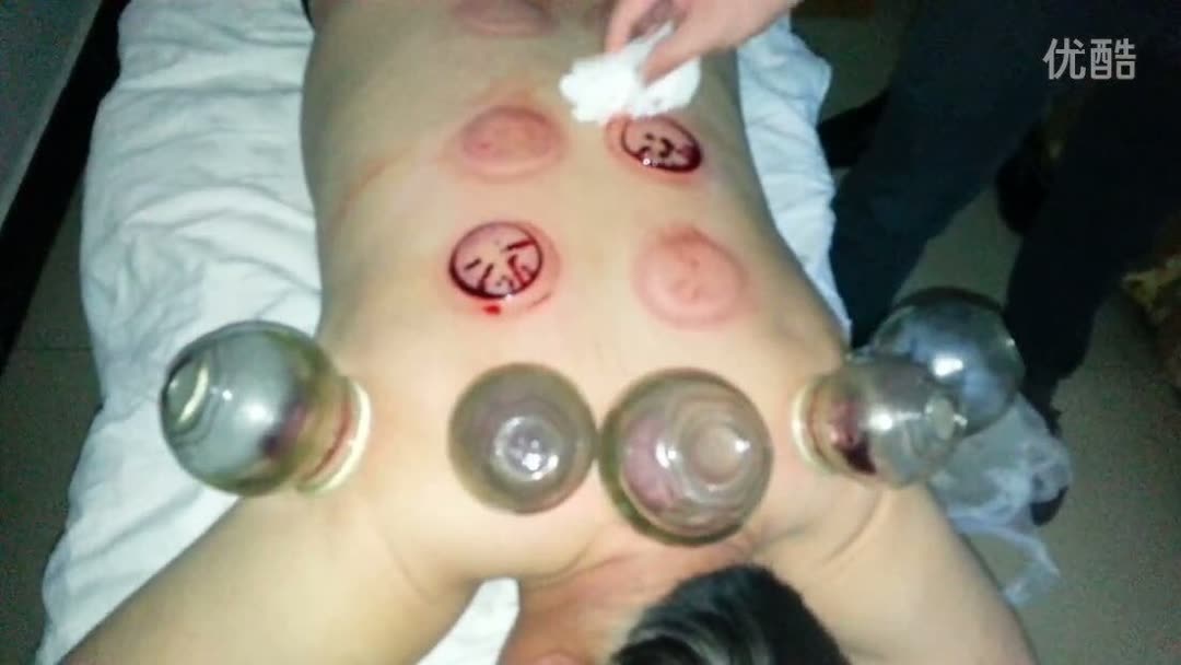 拔血罐自拍视频——霸气外漏