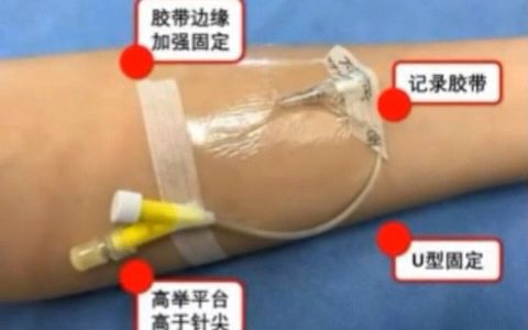 不会使用留置针?看完就会了!