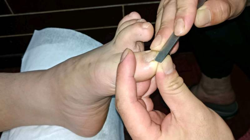 杨州修脚刀法之怎么挑甲沟炎