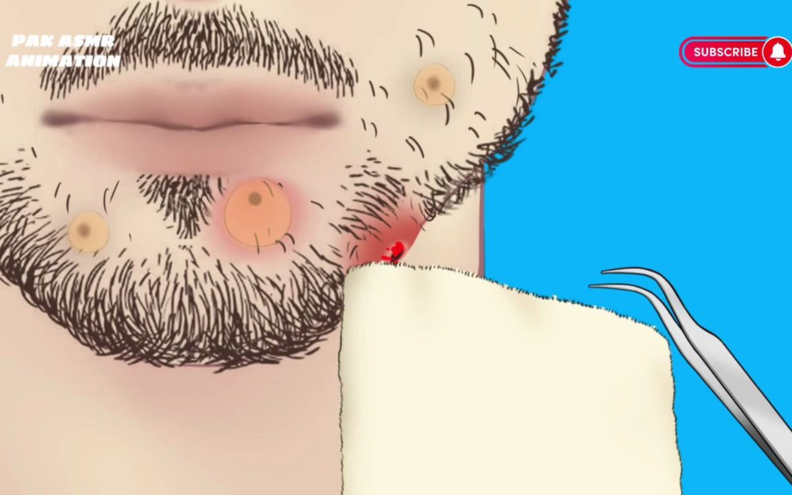 男孩痤疮治疗动画