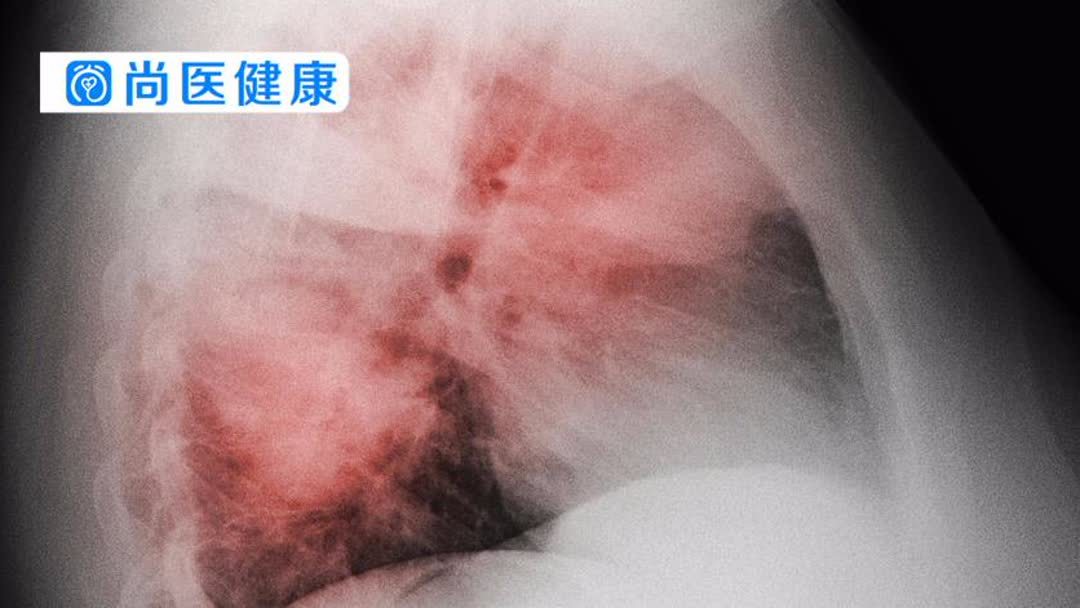 病毒性肺炎和细菌性肺炎有什么不同?快看看你属于哪一种?