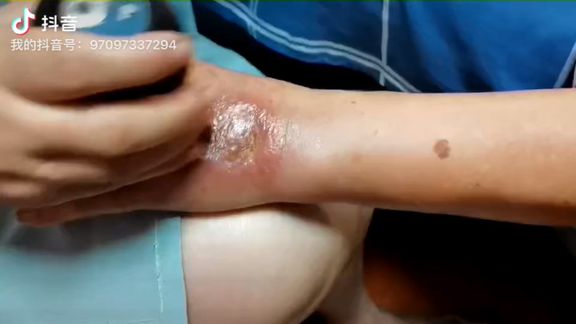 火龙罐治疗溃烂,消除炎症。