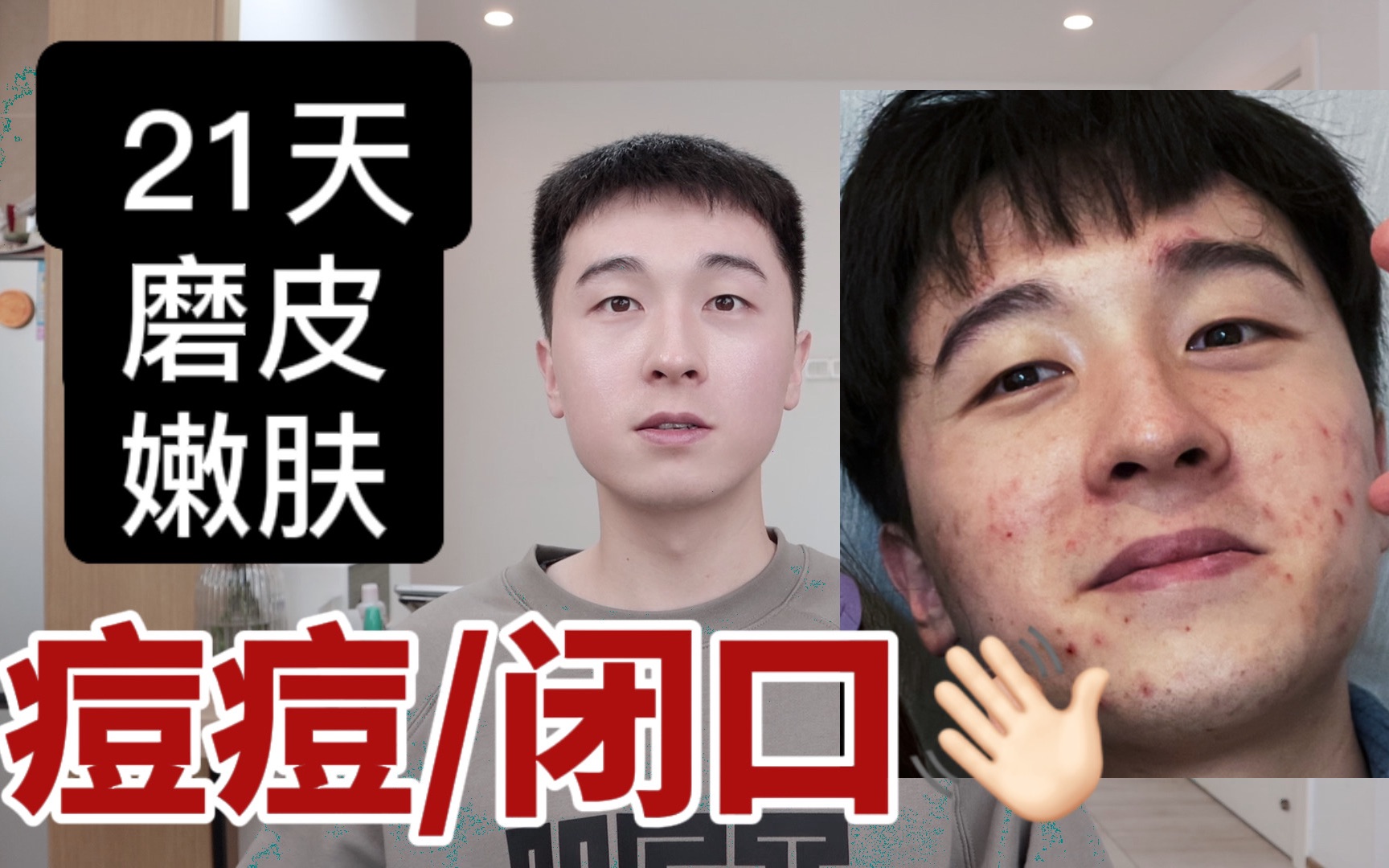 21天平痘痘闭口!一键get磨皮肌!