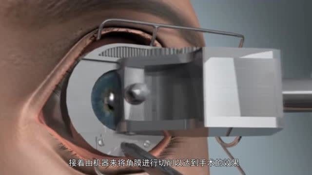 近视眼激光手术是怎么做的?3D模拟动画演示,看了你还敢做吗?