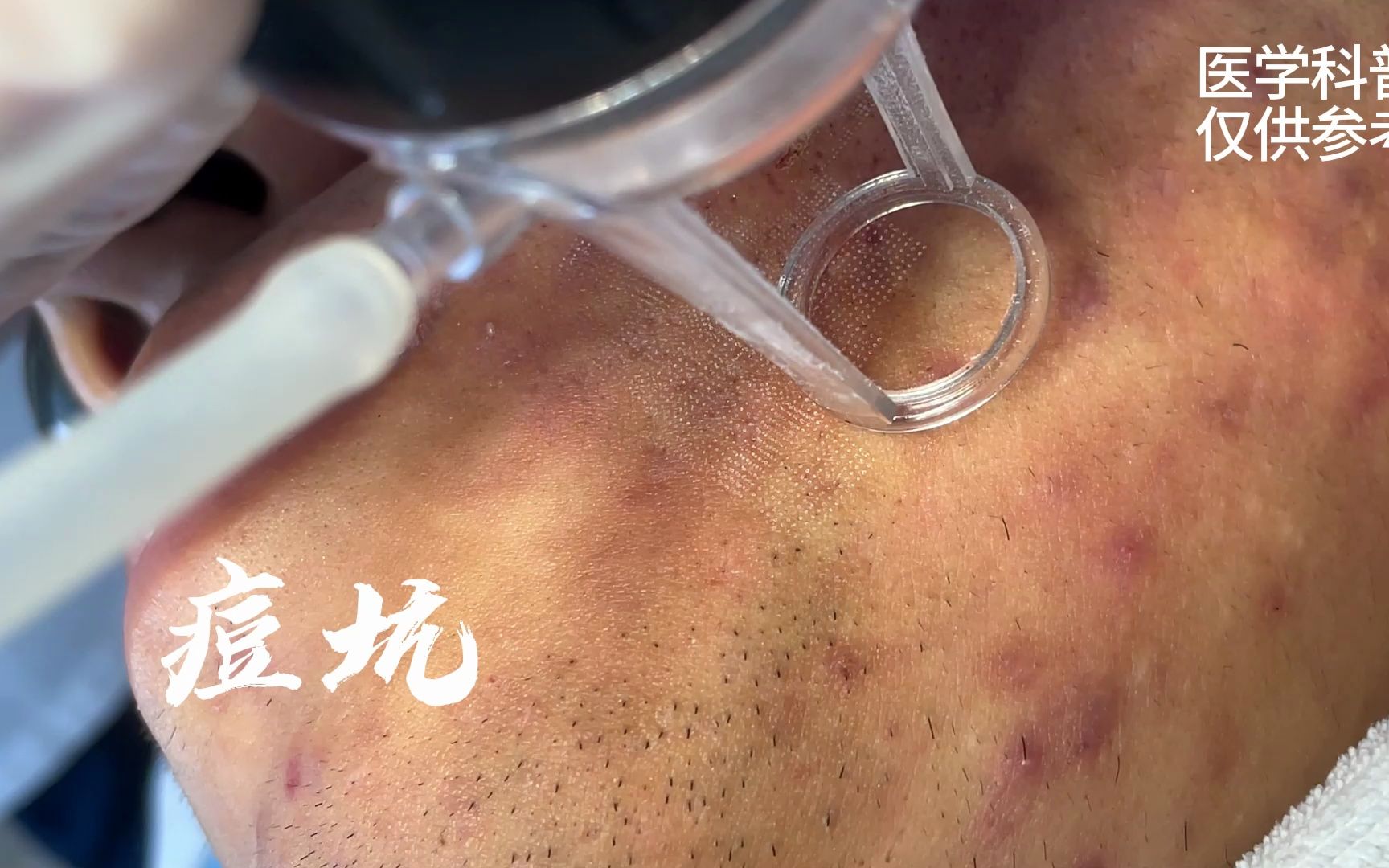 痘坑,痤疮疤痕的治疗实拍,欢迎点赞评论
