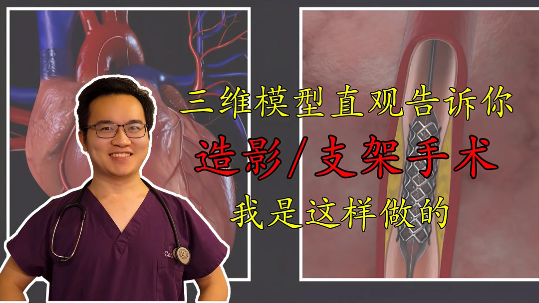 造影支架手术过程详解,心脏手术前你应该知道:微创≠没有损伤