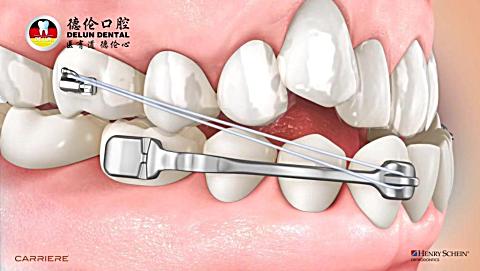 动画牙齿矫正视频全过程-地包天先打开咬合再内收, 操作效果示例