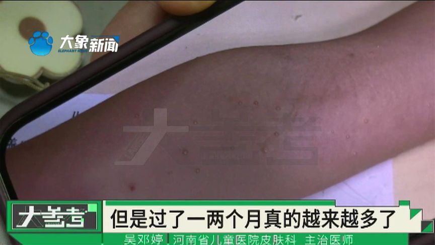 家长警惕!孩子身上长"痘痘",不痛不痒却可能是传染性皮肤病