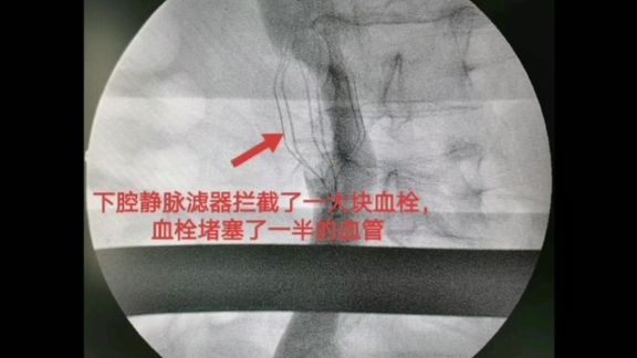 深静脉血栓是什么样子?快来看看