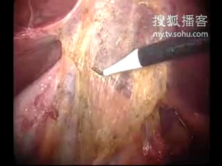 视频:腹腔镜胆囊切除术(2) - 大杂烩 - 搜狐圈子