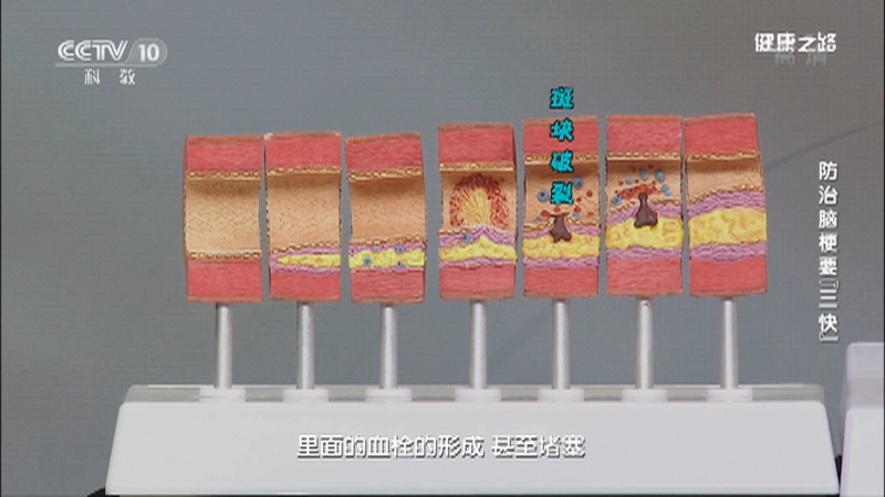 [健康之路]防治脑梗要“三快” 如何治疗脑卒中