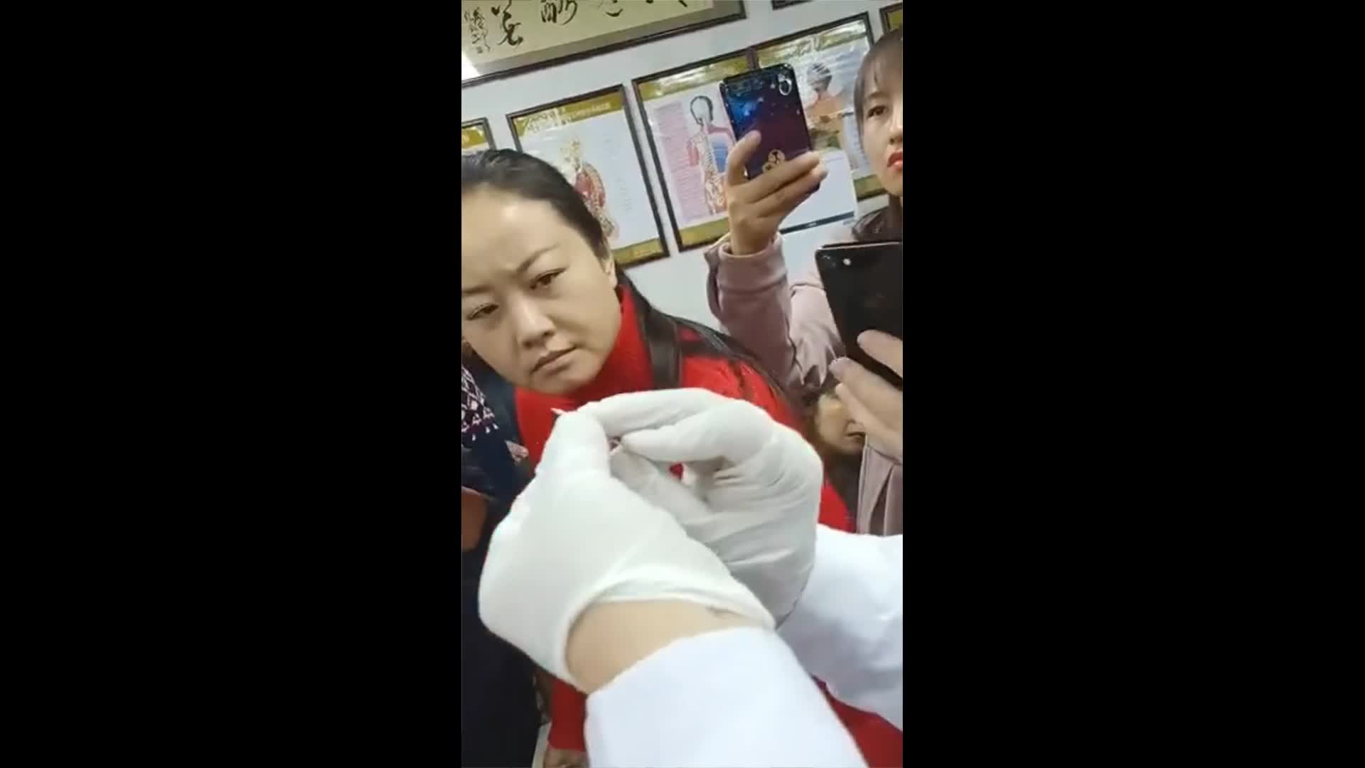 中医放血疗法王合民刺络放血之大椎穴放血视频