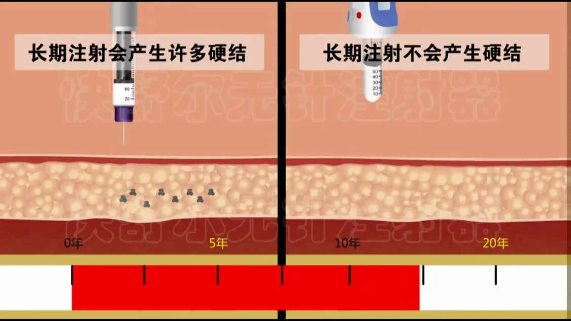 穿越糖潮(向红丁)- 糖尿病胰岛素无针注射器,控制并发症及血糖