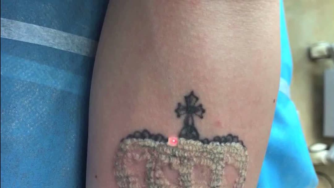 2018年洗纹身现场皮秒洗纹身洗手臂内侧皇冠