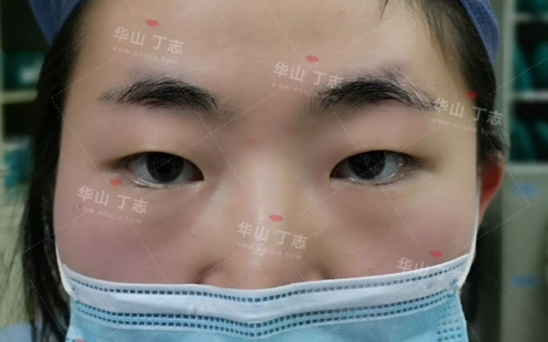 肿眼泡的人,做完双眼皮到底有多好看?