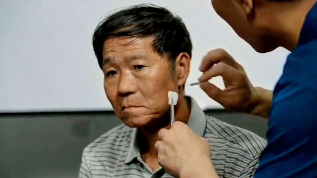 贺氏火针加点刺放血治面瘫:面部操作手法要快,下针前一定要消毒