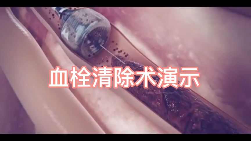三种血栓清除术科普演示,已收藏!