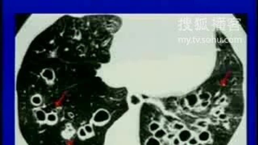 支气管扩张