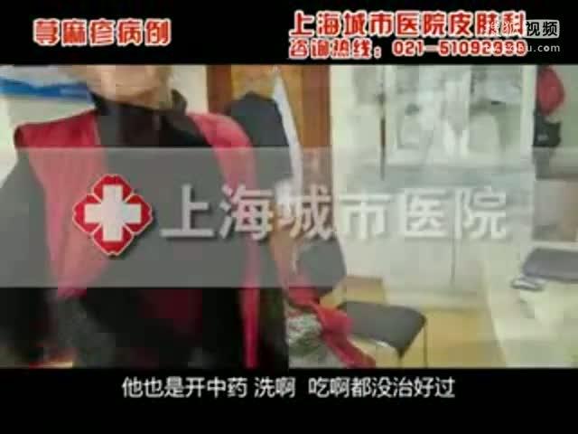 荨麻疹在线咨询-上海城市医院皮肤科
