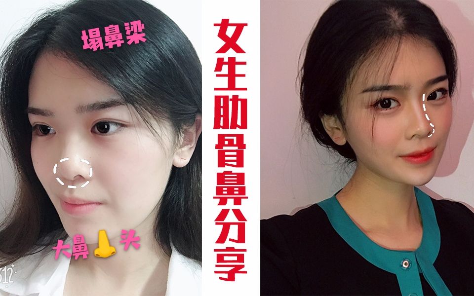 分享篇丨大鼻头、塌鼻梁怎么改善?女生肋骨鼻分享~
