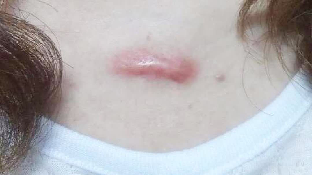 身上出现红色疙瘩不痛不痒 摸起来硬硬的 医生说可能是得了这个皮肤病