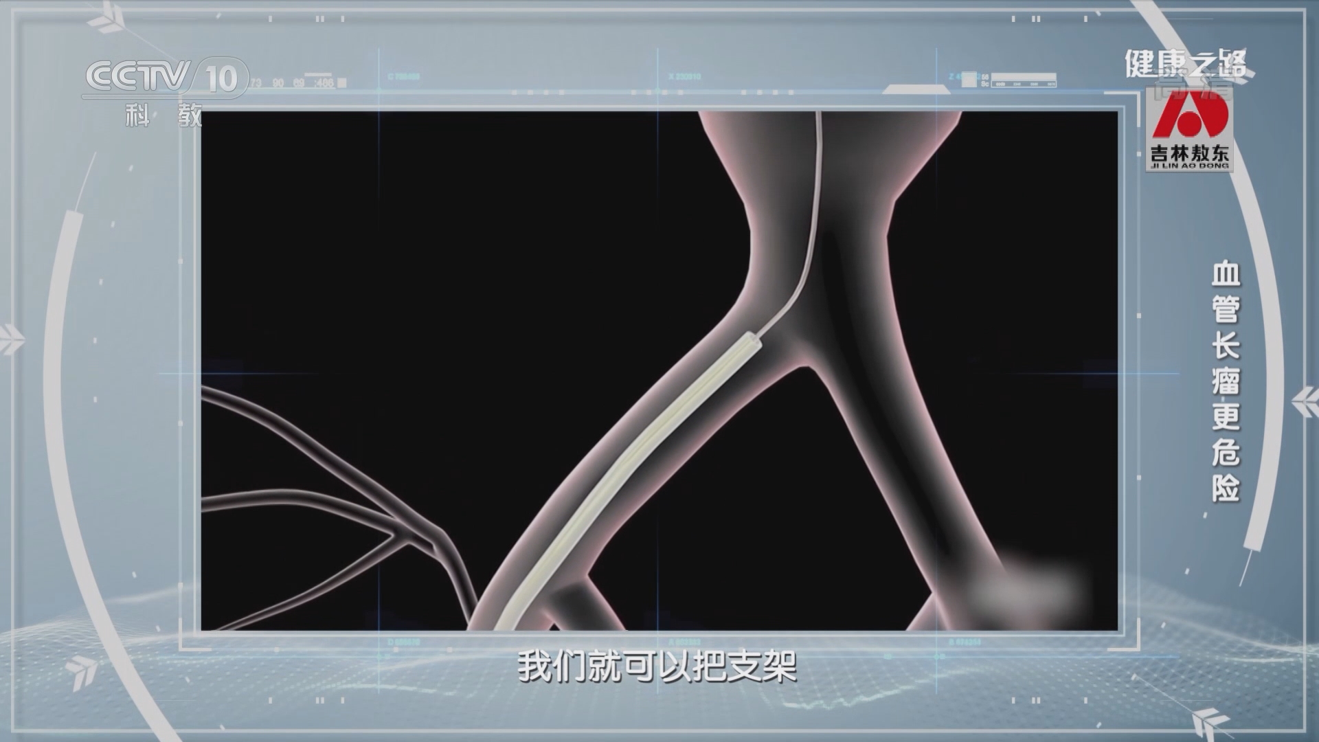 [健康之路]血管长瘤更危险 治疗主动脉瘤