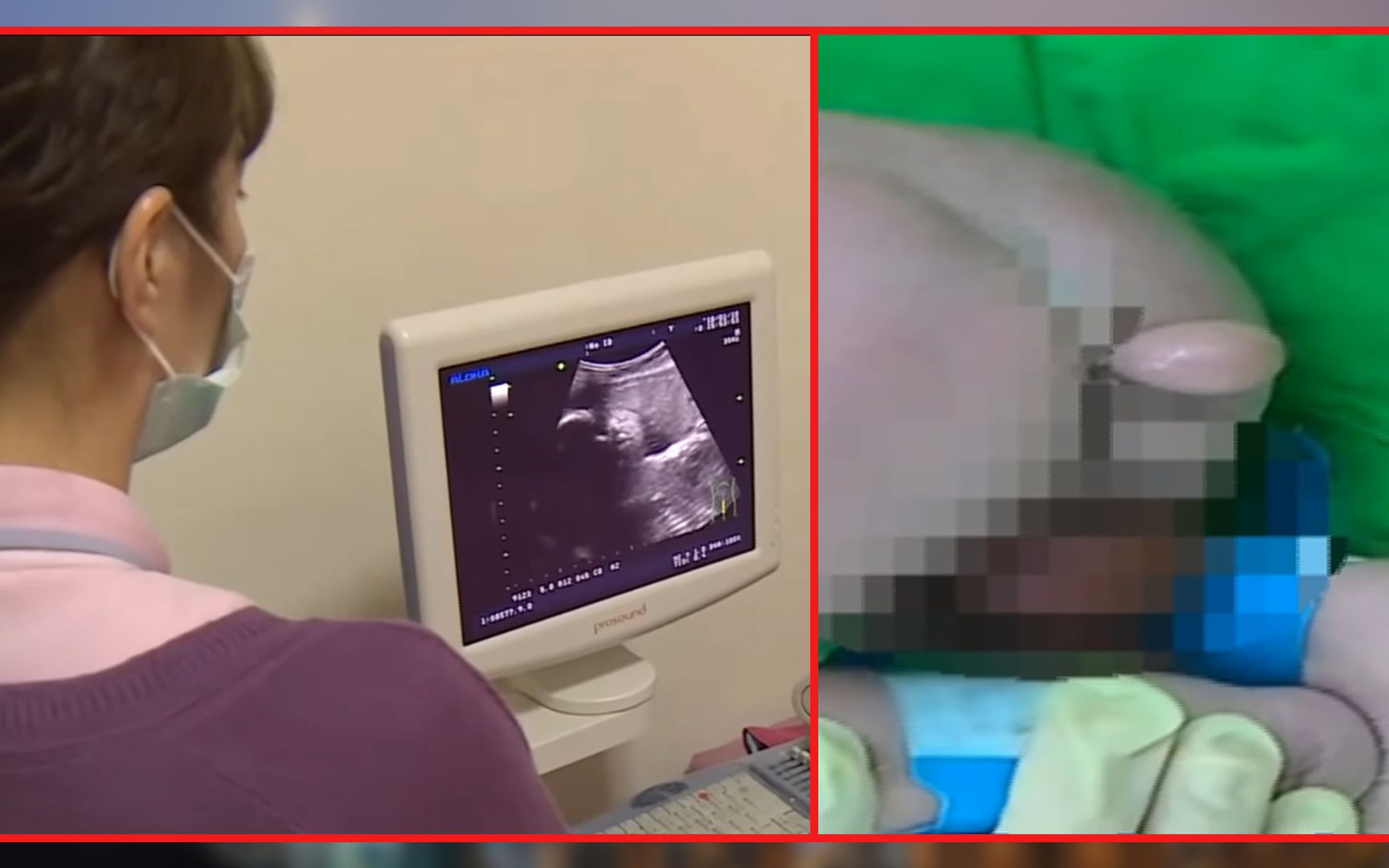 刚出生的小宝宝竟然长出“兔子尾巴”,宝宝脊椎末端长了尾巴般的肿瘤