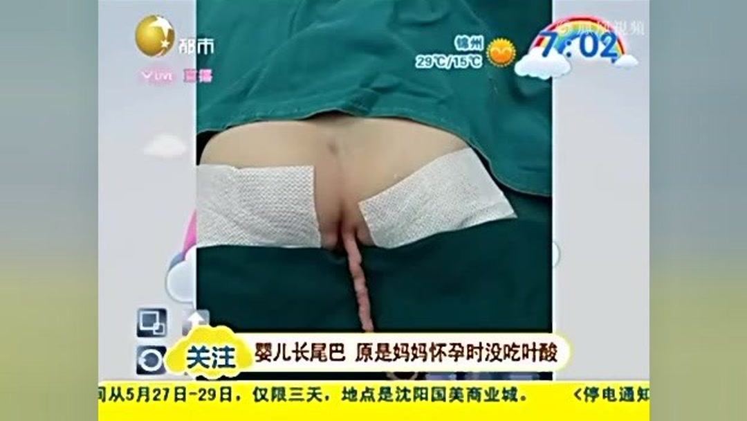 刚出生婴儿长出15厘米“尾巴” 只因妈妈少吃了一样