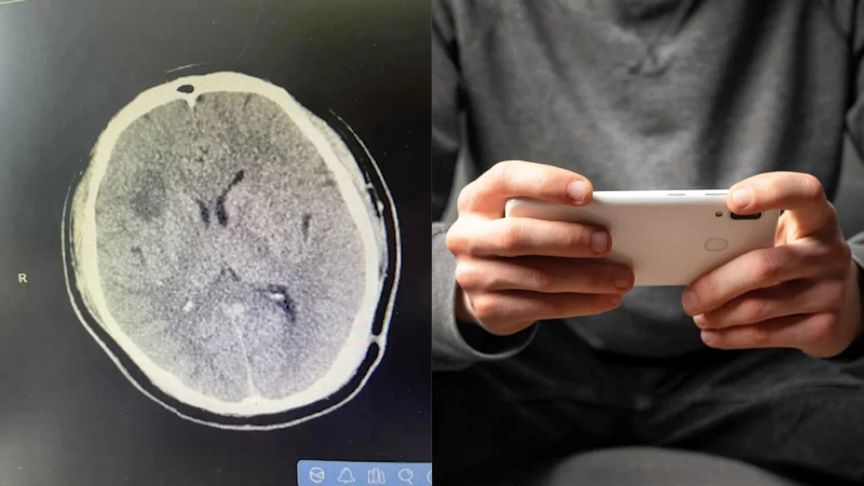 22岁小伙游戏上瘾熬夜,一觉醒来半身动不了,送医时已脑梗致偏瘫