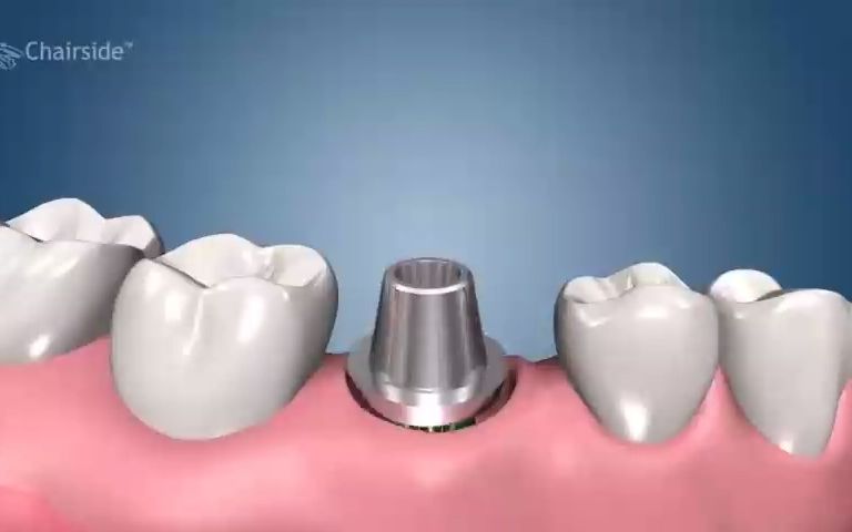 三维小短片带你了解种植牙全过程+医疗三维动画