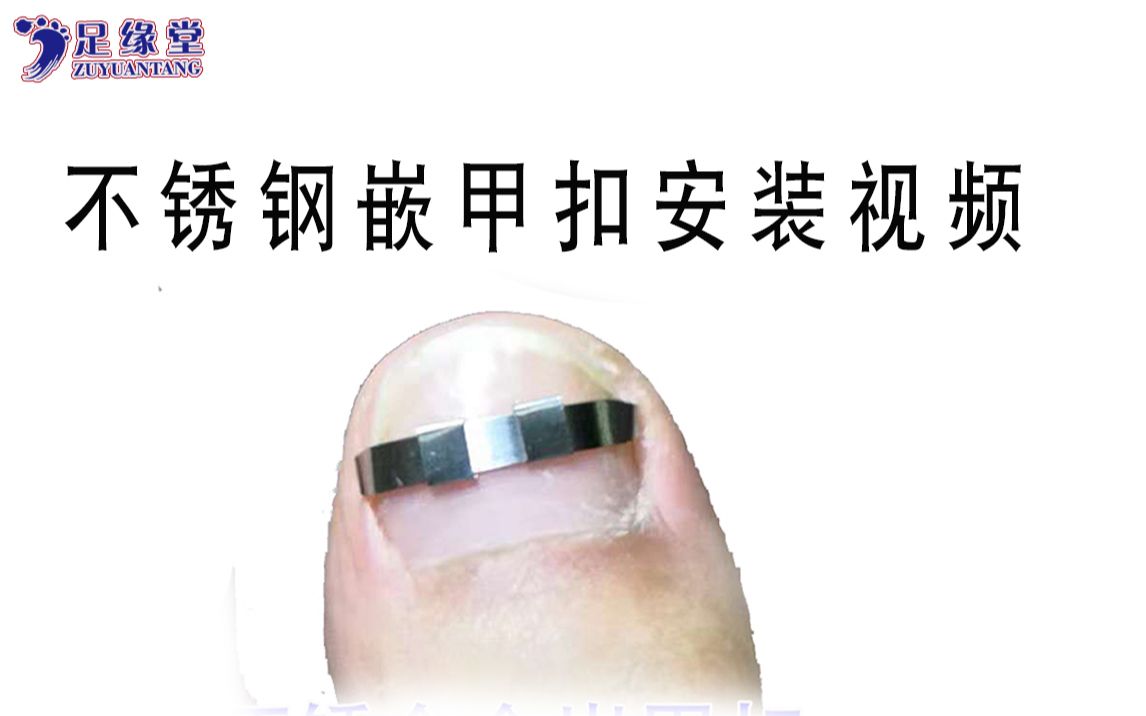手把手教你做嵌甲矫正-不锈钢嵌甲扣制作安装-甲沟炎嵌甲卷甲解决方法