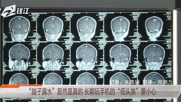 脑子漏水"居然是真的"长期玩手机的低头族要小心