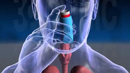 三维效果图解--支气管扩张剂useofbronchodilator