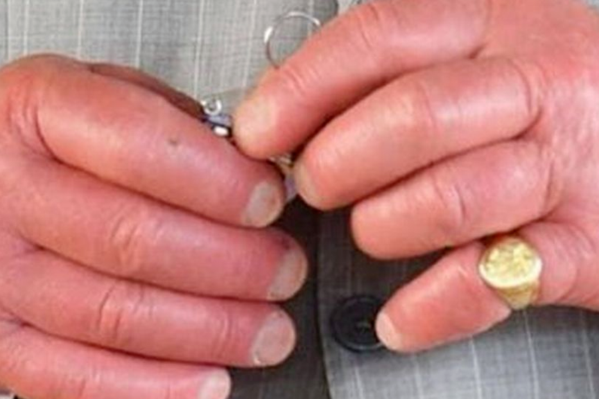 英国新国王身体出问题了,手指已肿成“香肠”,医生看后解答病况