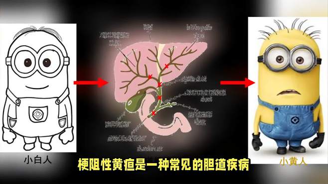 梗阻性黄疸患者的福音-彩超引导下经皮肝穿刺胆管引流术