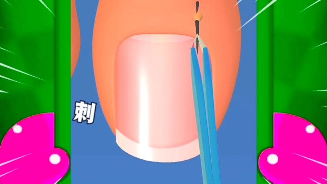指甲模拟器:小舞的脚趾头被刺插进去了,我该怎么办