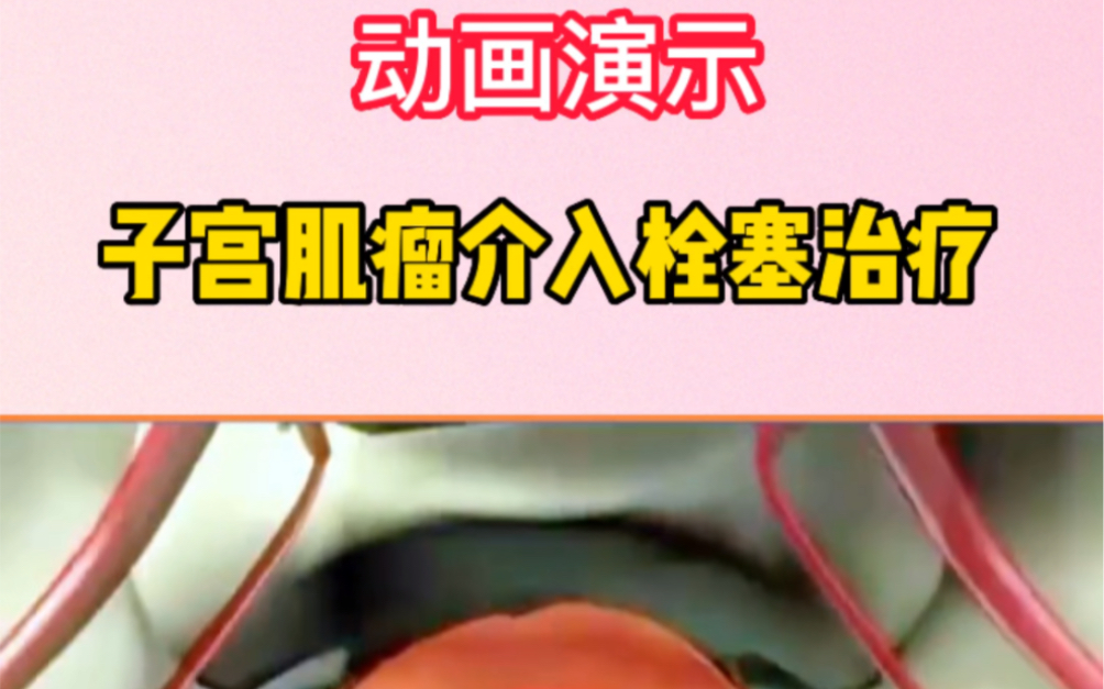 动画演示:子宫肌瘤介入栓塞治疗