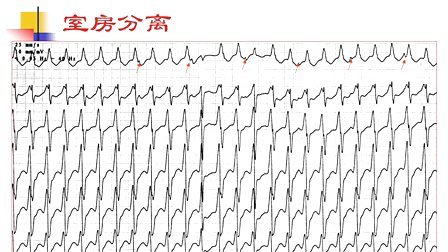 中国医学资源网csosn.net郭继鸿--aVR导联鉴别新流程