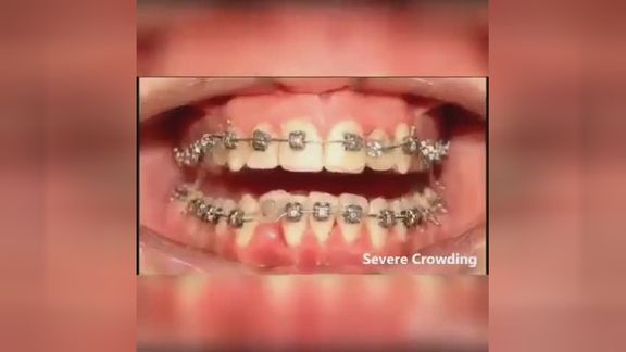 满足好奇心!这个视频告诉你牙齿正畸的过程是什么样子的
