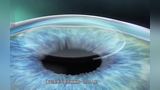 激光治疗近视手术怎么做?3D动画模拟,看完你还敢做吗?