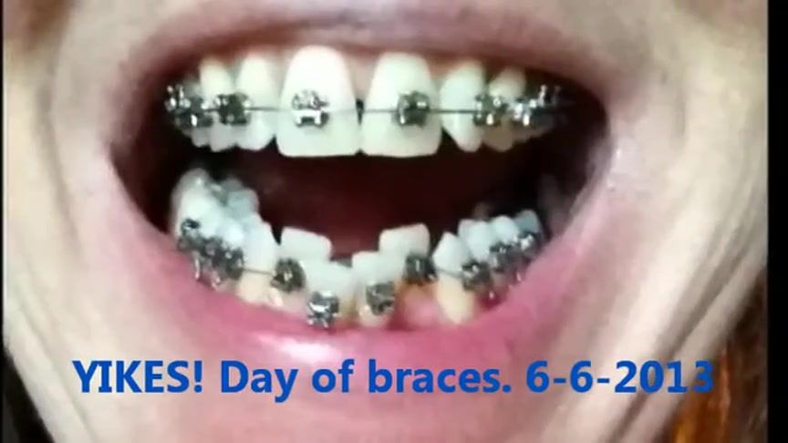 牙齿是如何变整齐的?有位博主记录了他的正畸过程!