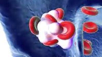 肺栓塞3D动画(国外