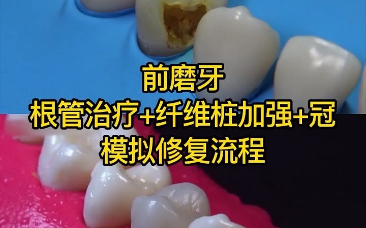前磨牙根管治疗+纤维桩加强+冠模拟修复流程