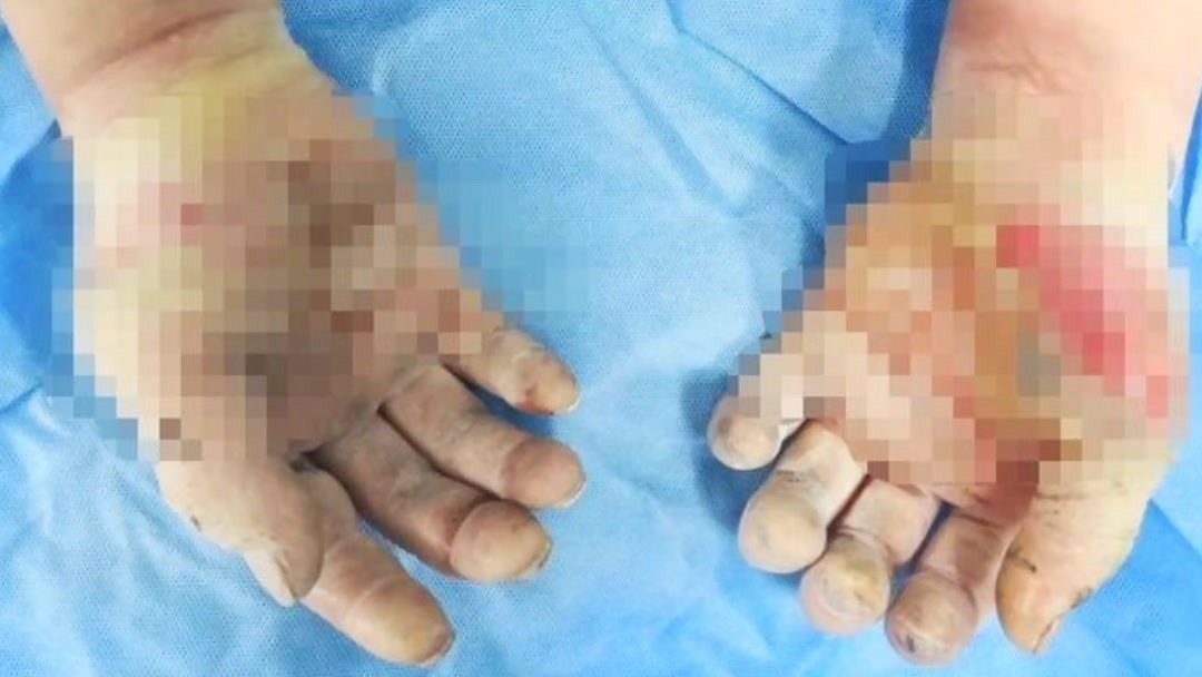 杭州一市民“酒精消毒”后烤电暖气全身着火,全身15%烧伤!