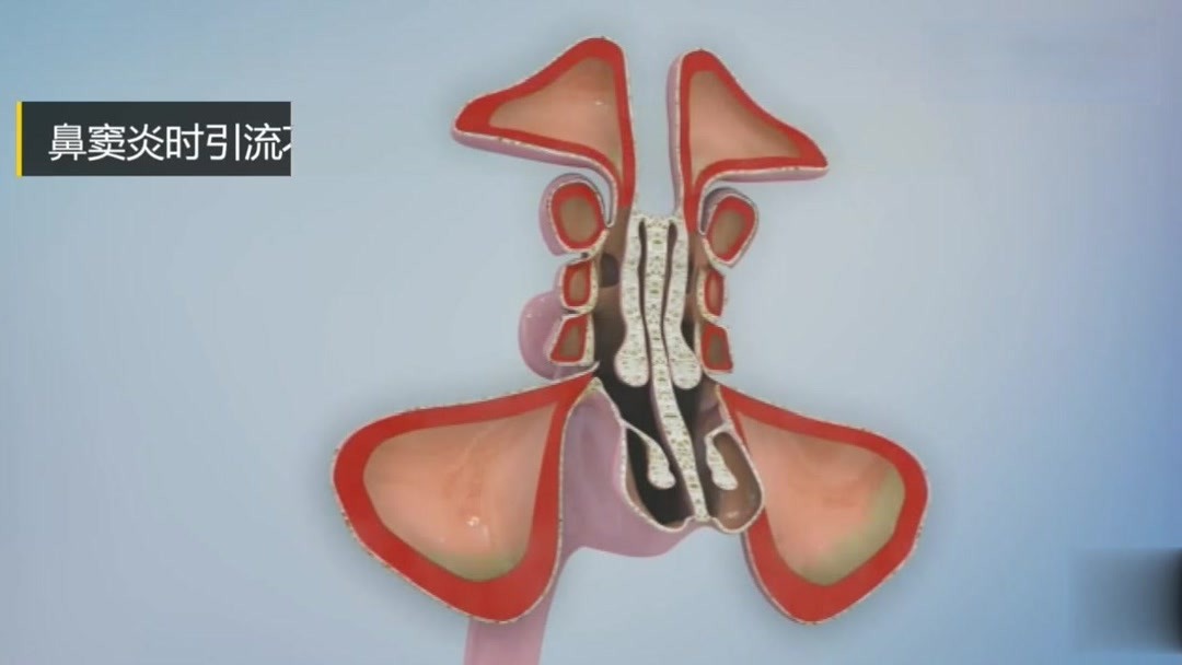 鼻窦炎如何手术治疗?3D动画演示鼻内窥镜下微创手术