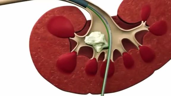 肾结石微创手术过程3D动画演示