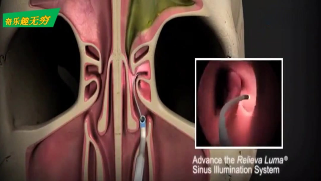 鼻窦炎多痛苦你知道吗?3D演示鼻炎手术,做完呼吸都顺畅了